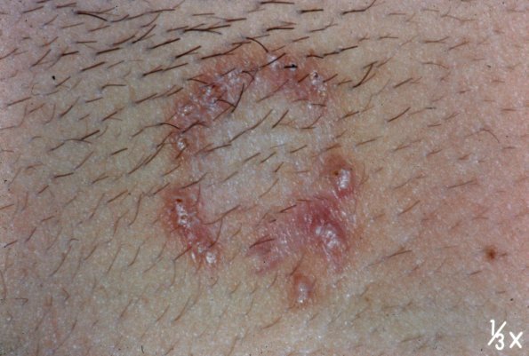 PICT0001 | Elastosis perforans serpiginosa | Dr. Ken Hashimoto | Wayne State University SOM ...